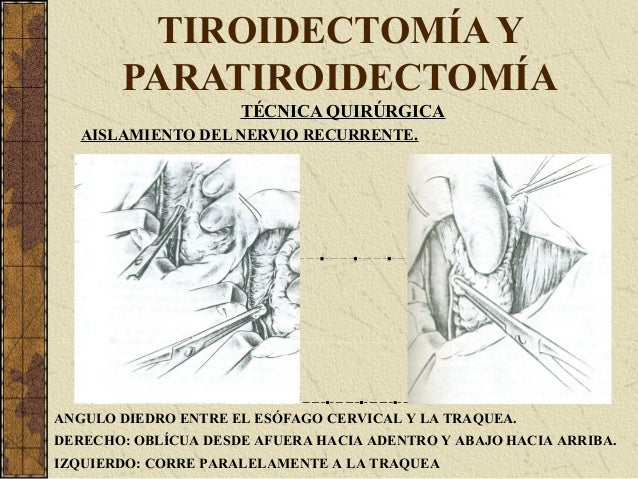 Tiroidectomía y paratiroidectomía