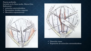 Tiroidectomia Cirugia General Y Quirurgica Pptx