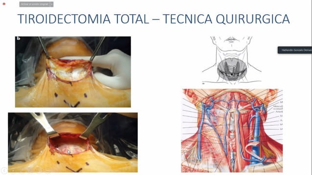 TIROIDECTOMÍA TIROIDES CIRUGIA GENERAL.pdf | Thyroid Disorders ...