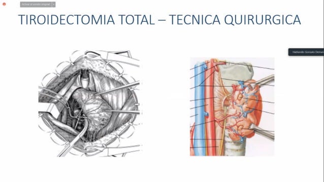 TIROIDECTOMÍA TIROIDES CIRUGIA GENERAL.pdf | Thyroid Disorders ...