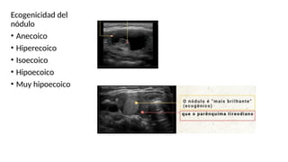 TIROIDES clasificacion de la glandula 1.pptx