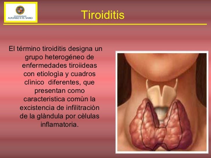 Tiroiditis: Qué Es, Principales Tipos, Síntomas Y Tratamiento – BJJJZ
