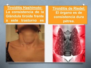 Tiroiditis | PPTX