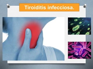 Tiroiditis | PPTX