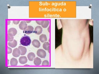 Tiroiditis | PPTX
