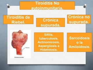 Tiroiditis | PPTX