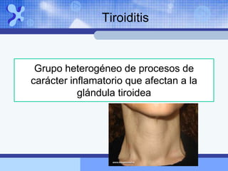 Tiroiditis. Patologías inflamatorias de la Glándula Tiroides.ppt
