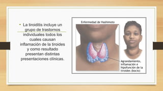 TIROIDITIS: La inflamación de la tiroides puede deberse a muchos ...