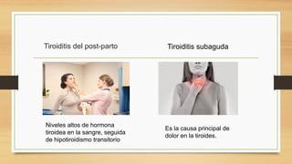 TIROIDITIS: La inflamación de la tiroides puede deberse a muchos ...