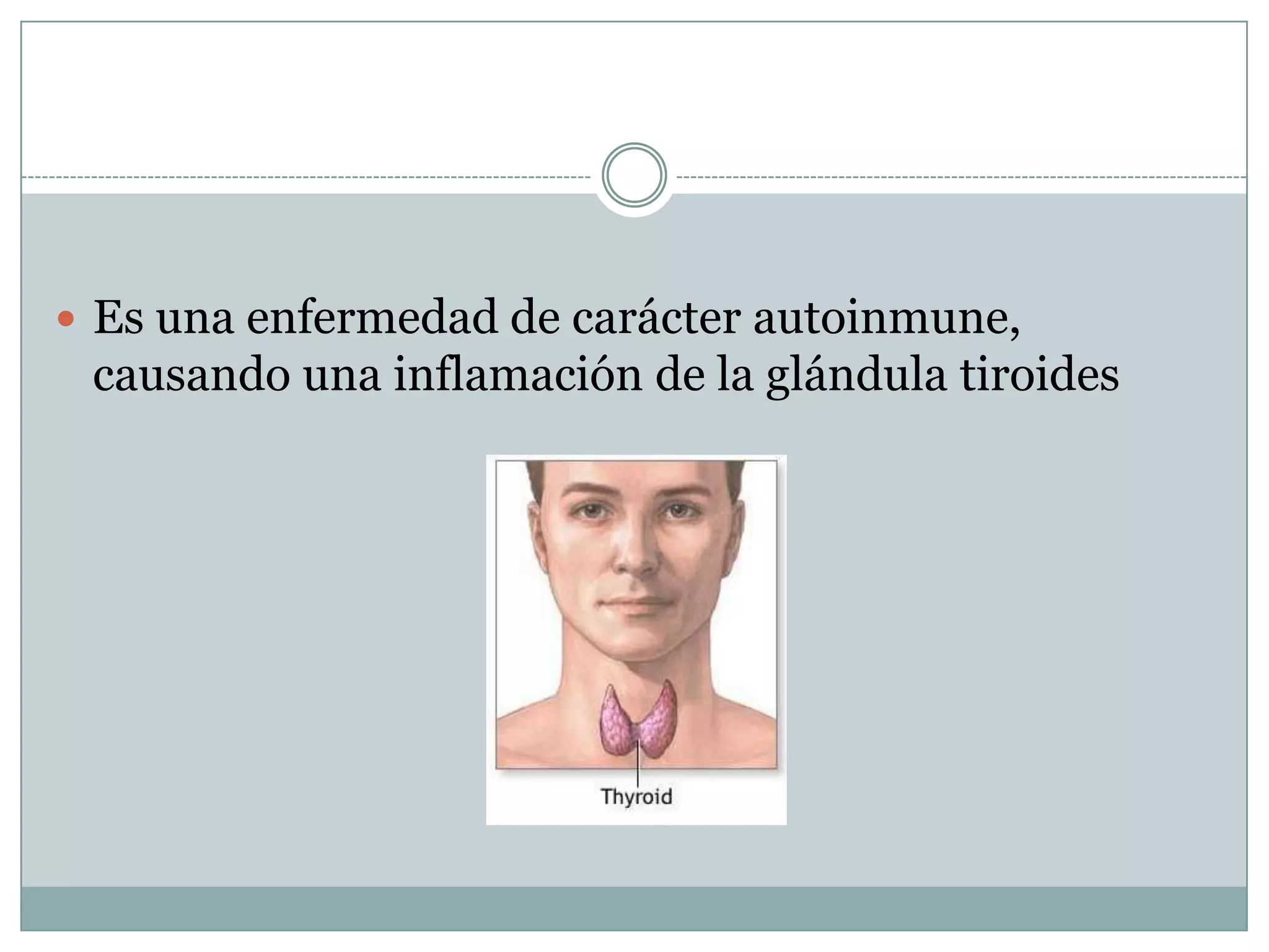 Tiroiditis de Hashimoto | PPTX