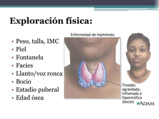 Tiroiditis de hashimoto | PPTX
