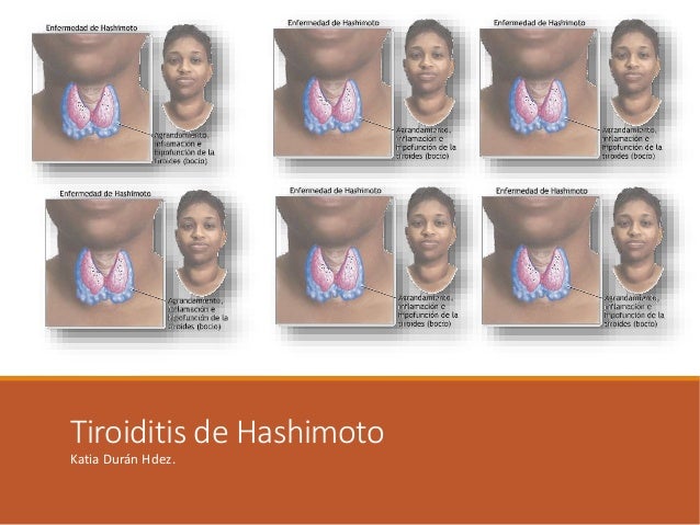 Tiroiditis de hashimoto