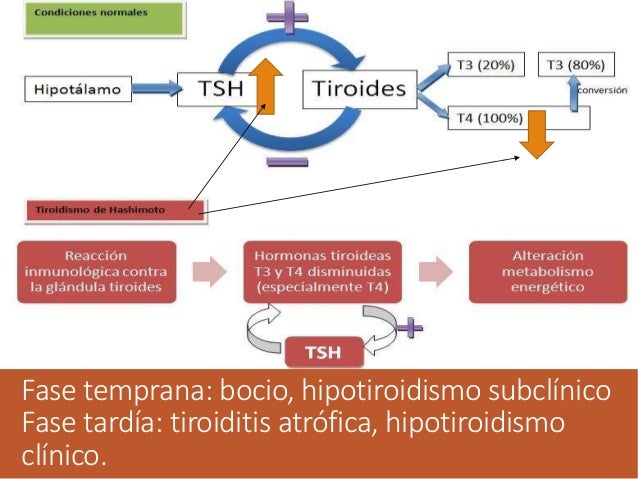 Tiroiditis de hashimoto