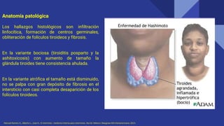 TIROIDITIS KARINA GOMEZ .pptx