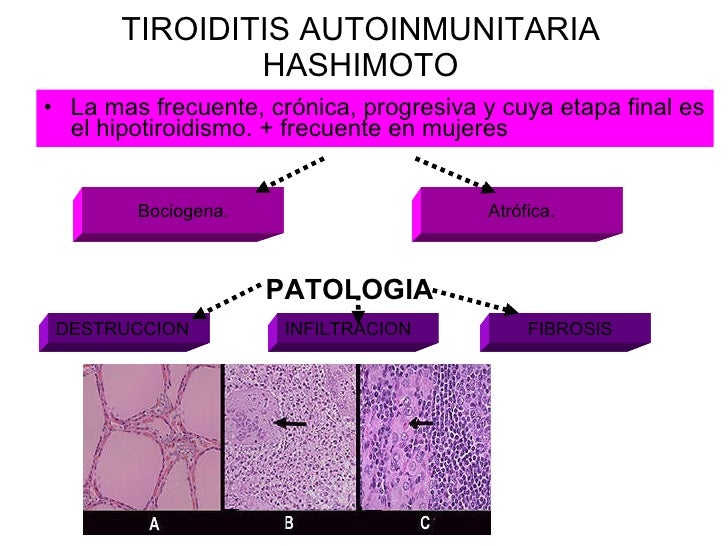 Tiroiditis