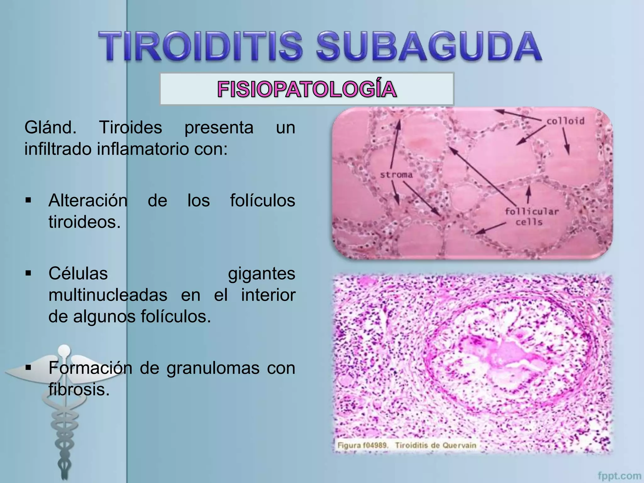 Tiroiditis subaguda - Huamanchumo Sandoval Samaria | PPT