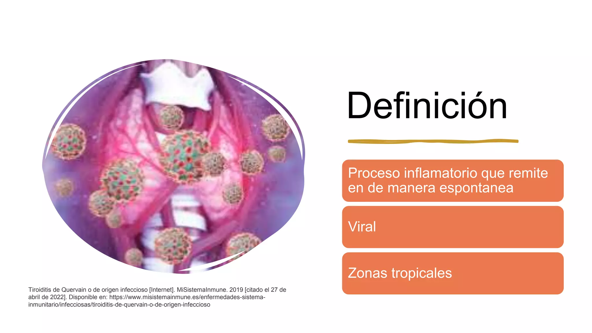 Tiroiditis subaguda o de Quervain.pptx