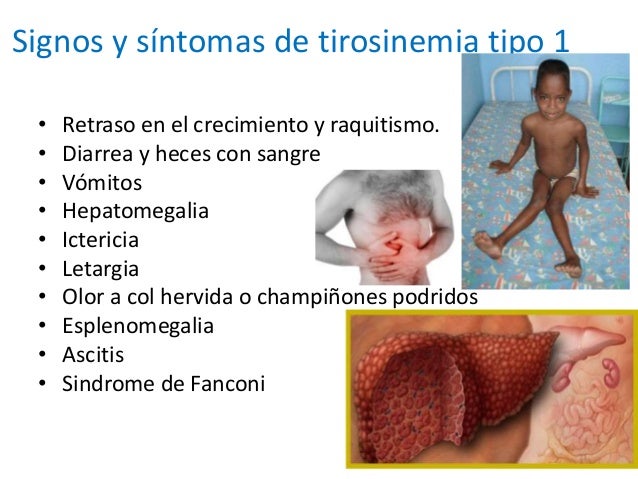 Tirosinosis