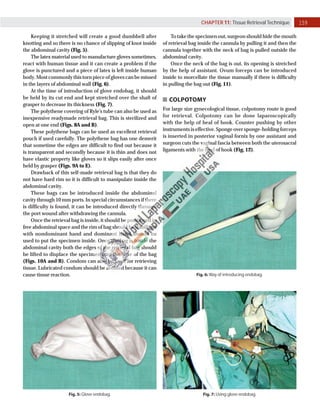 Tissue Retrieval Technique | PDF