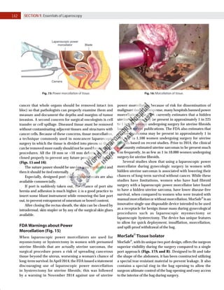 Tissue Retrieval Technique | PDF