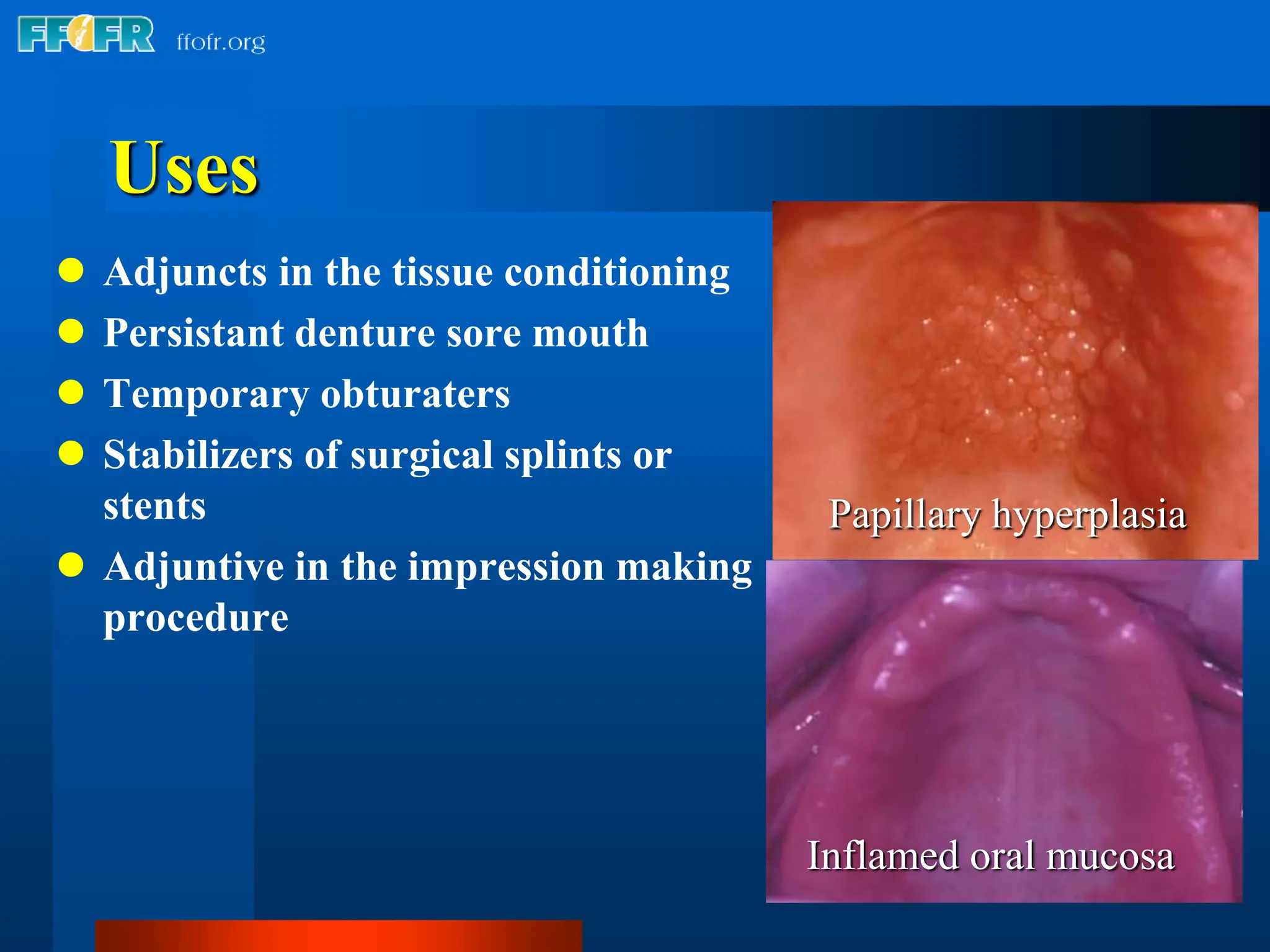 tissue conditioners 4th yr.ppthbhjjhsgjygdu | PPT