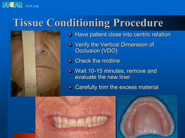 tissue conditioners 4th yr.ppthbhjjhsgjygdu | PPT