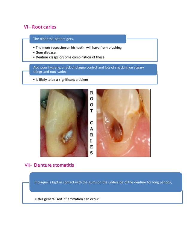 Tissue damage resulting from removable partial denture | DOCX