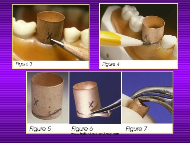 Tissue diplacement/ dentistry orthodontics