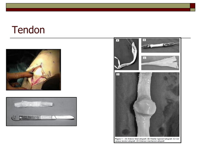 Tissue donation overview | PPT | Eye and Vision Conditions | Diseases ...