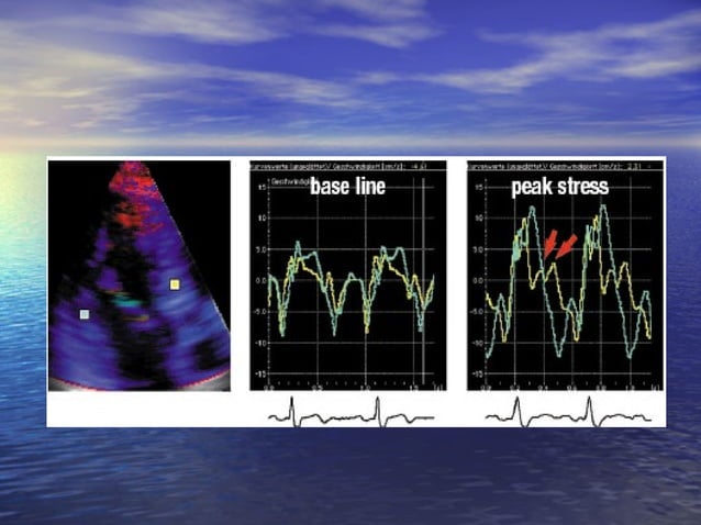 Tissue doppler imaging | PPT
