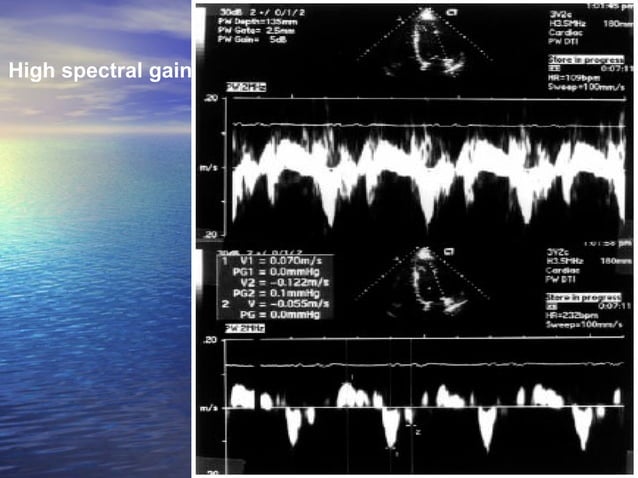 Tissue doppler imaging | PPT