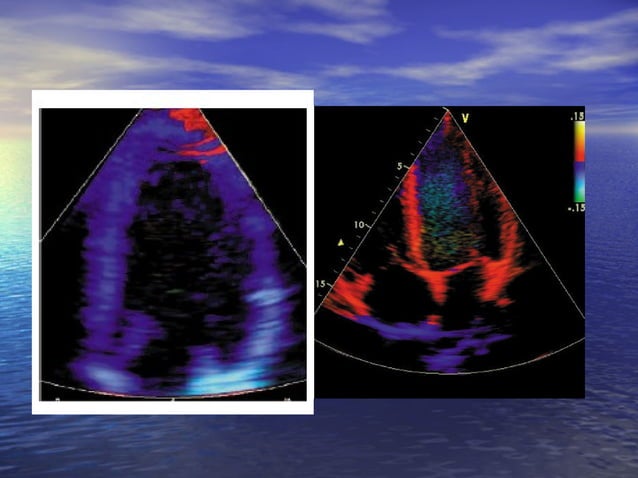 Tissue doppler imaging | PPT