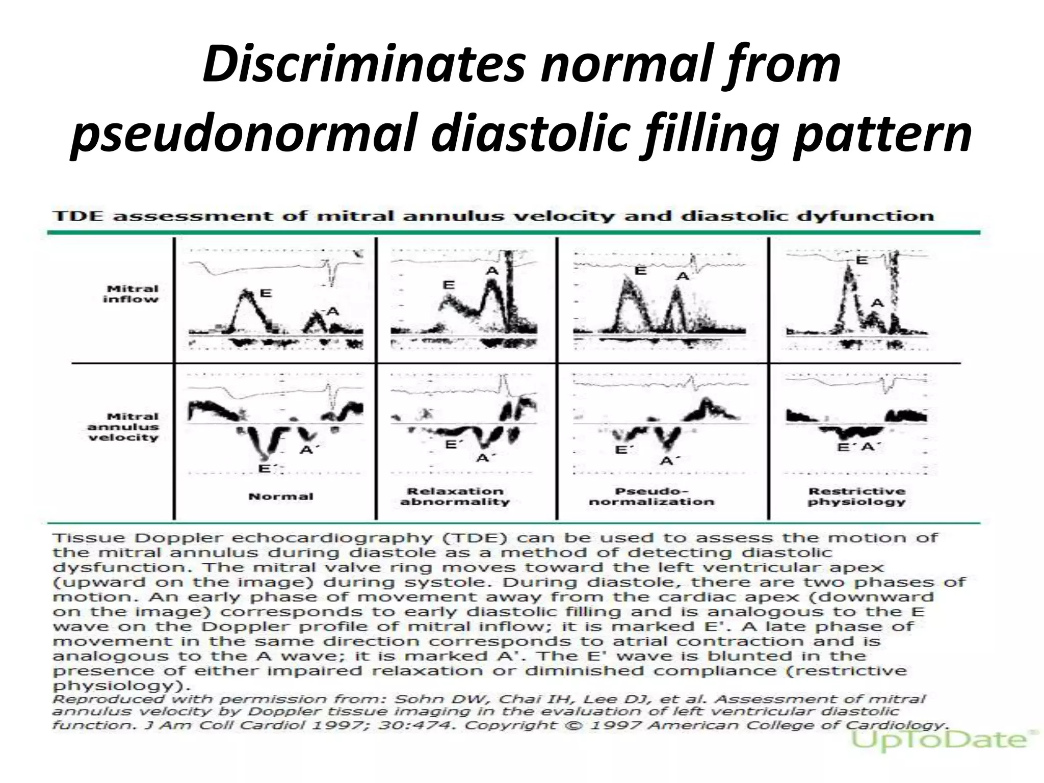 Tissue doppler Echocardiography (TDE) | PPTX