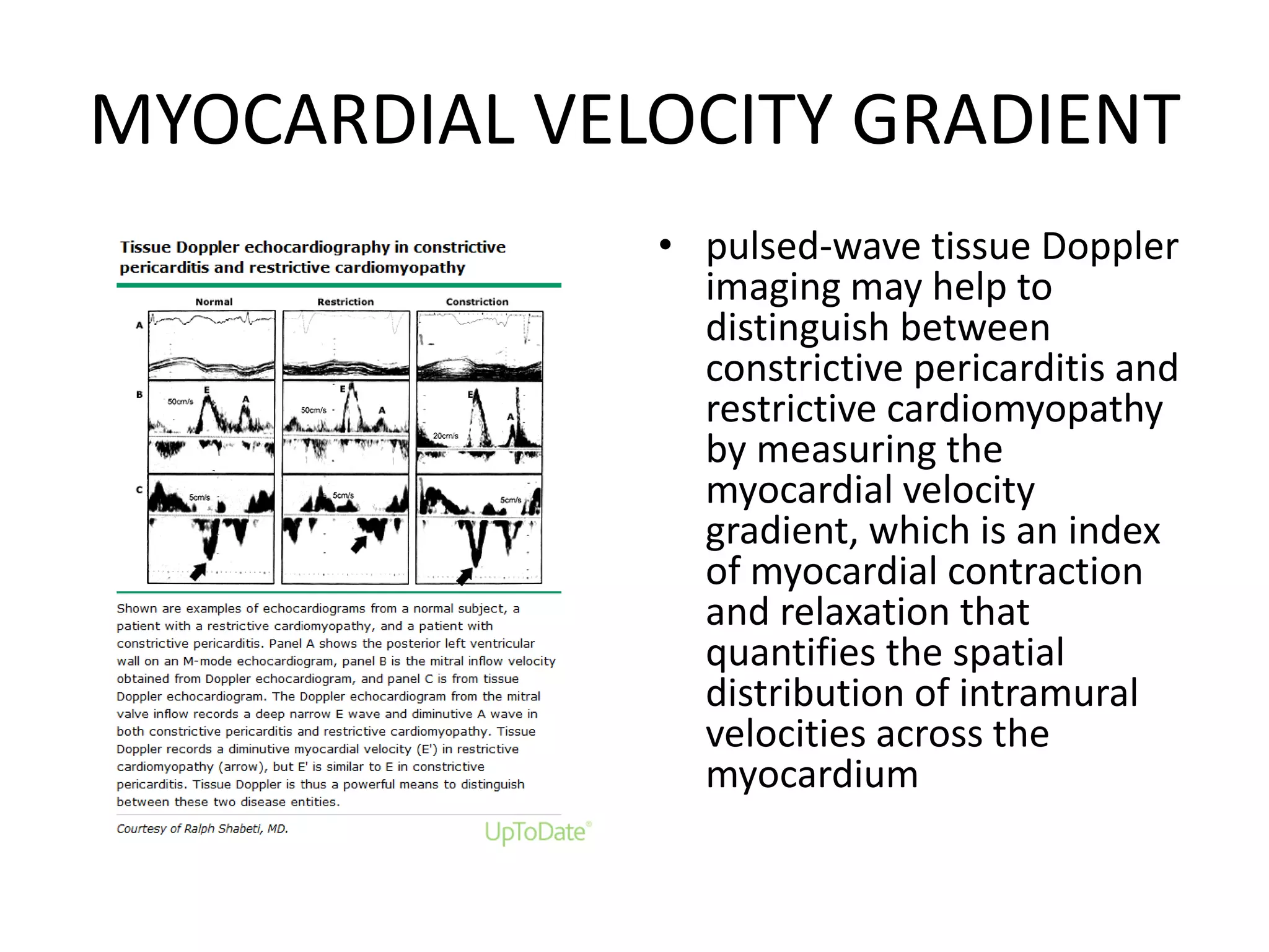Tissue doppler Echocardiography (TDE) | PPTX