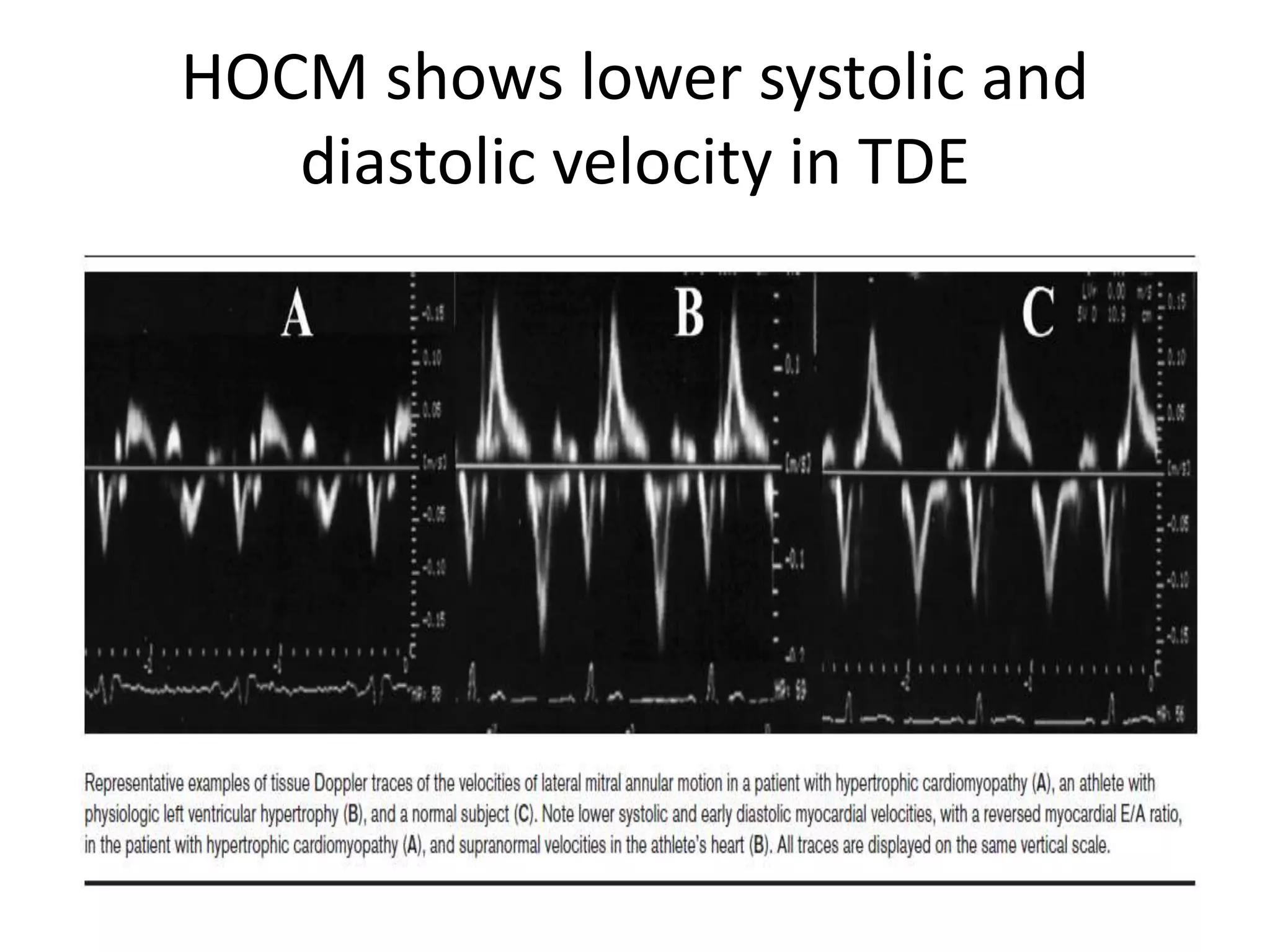 Tissue doppler Echocardiography (TDE) | PPTX