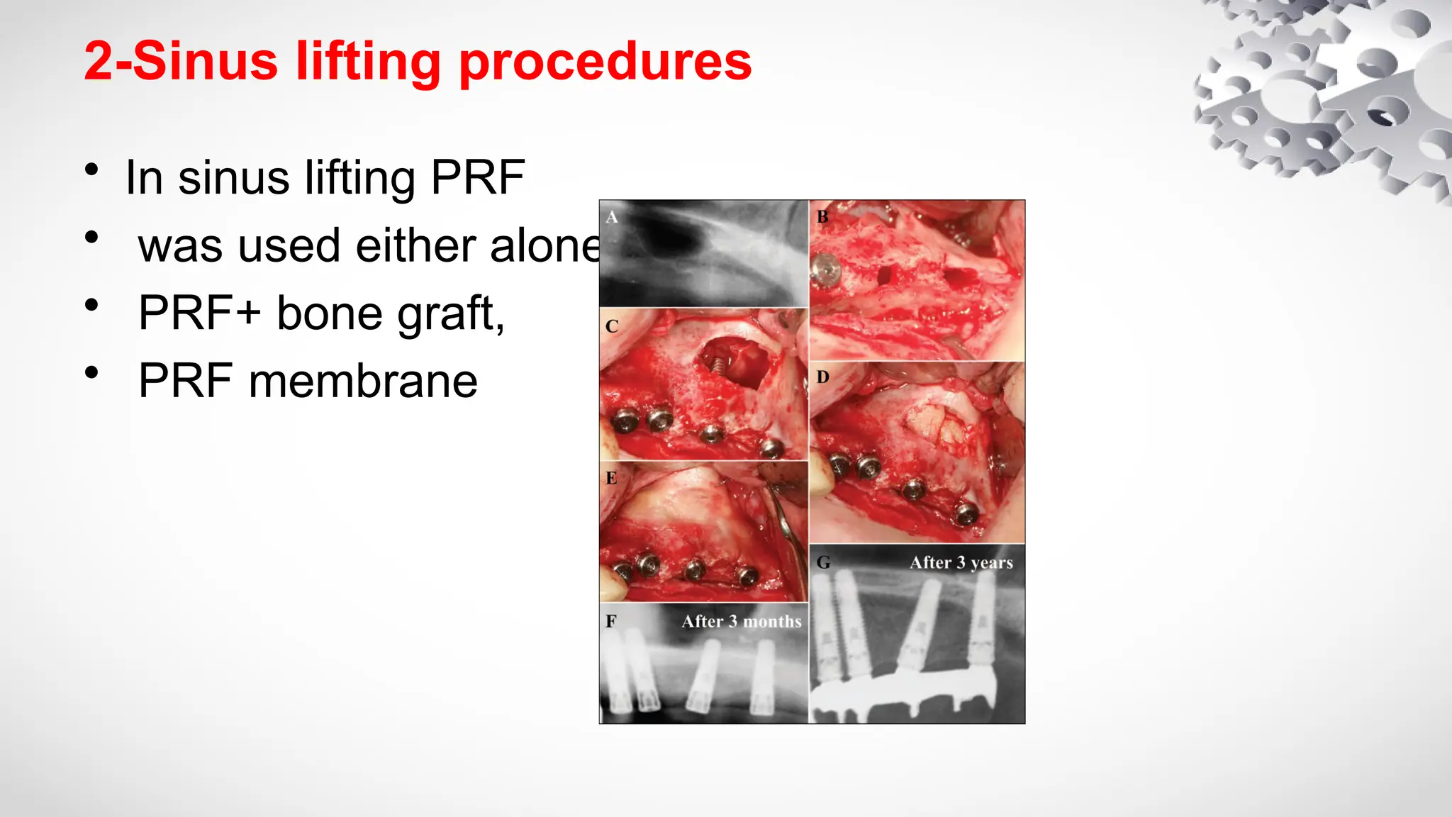 tissue engeneering for dental implant .pptx
