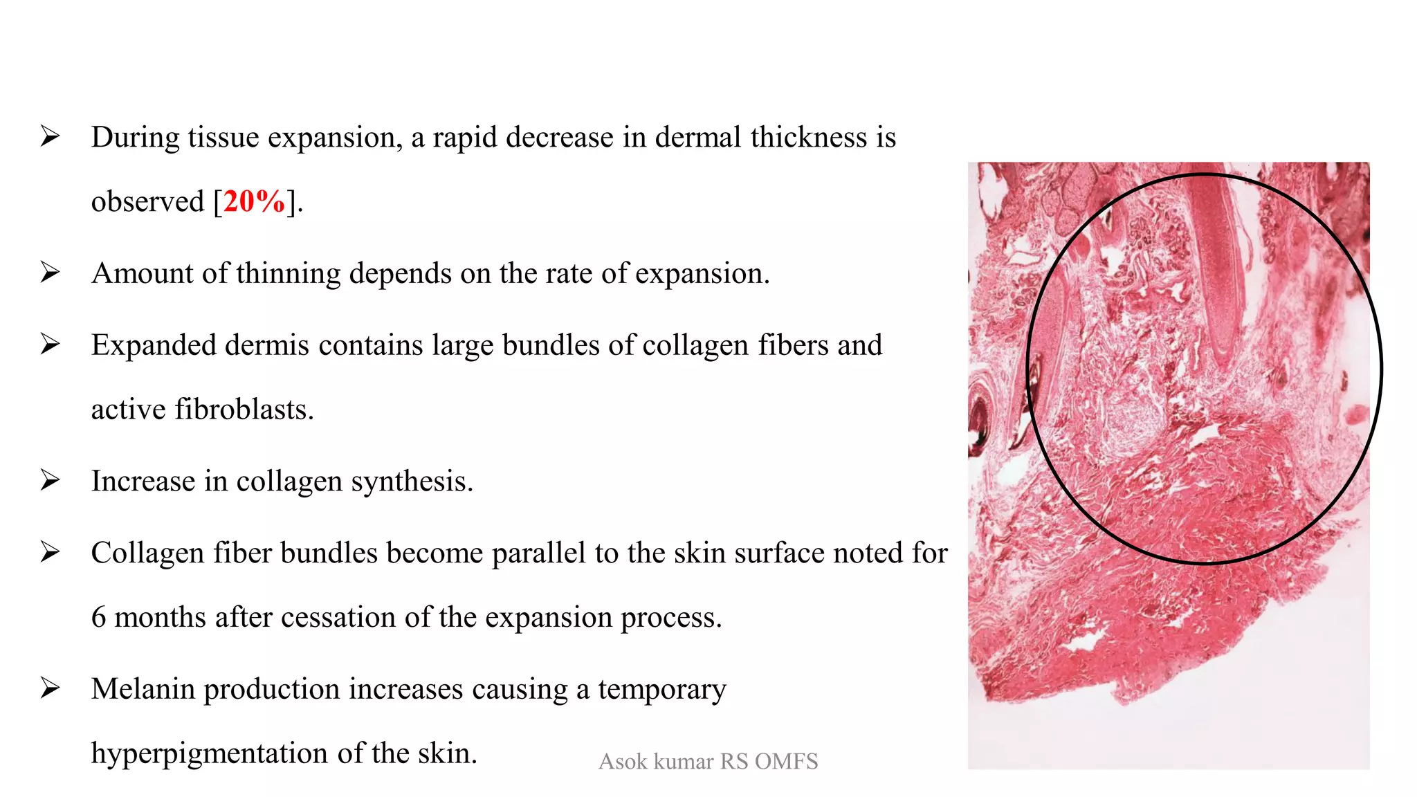 Tissue expander in omfs | PDF