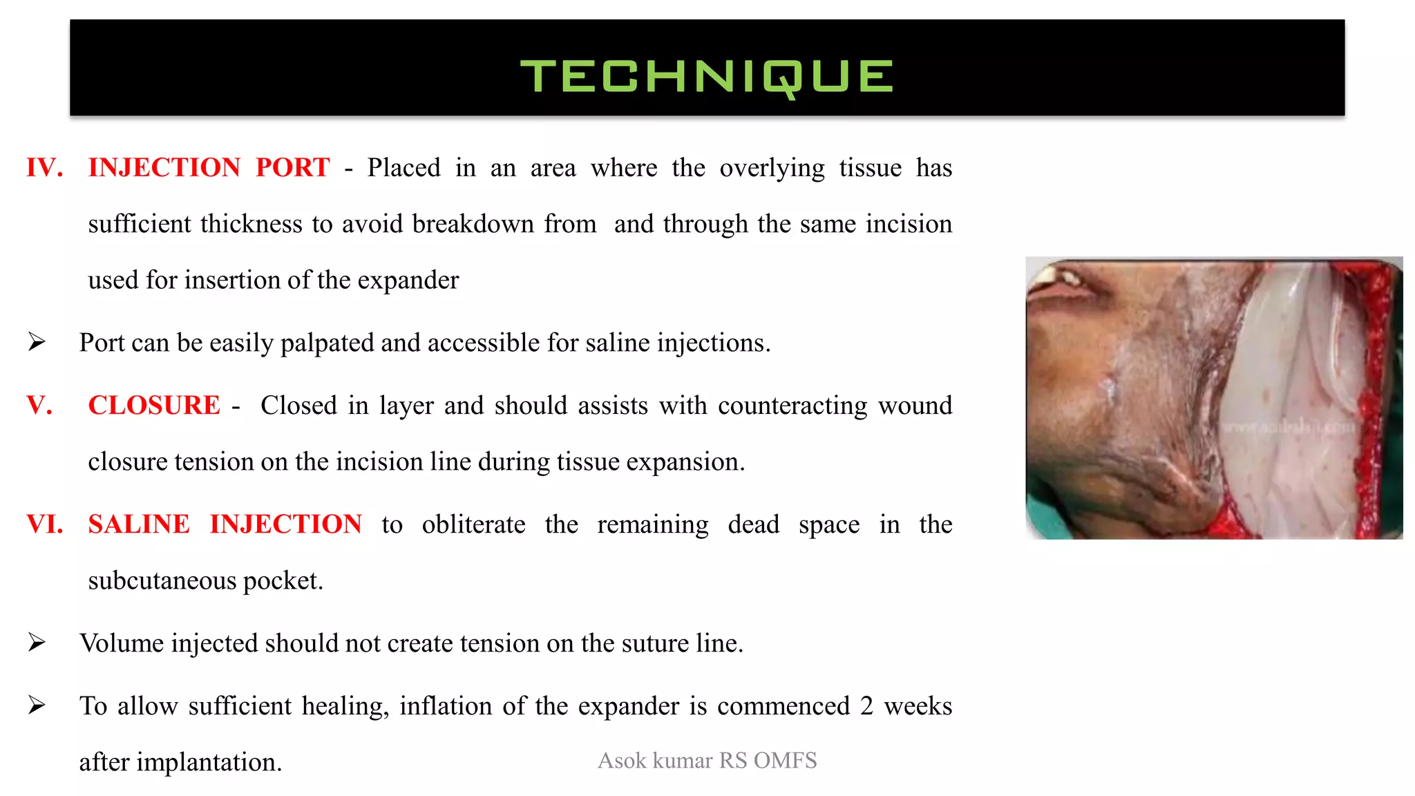 Tissue expander in omfs | PDF