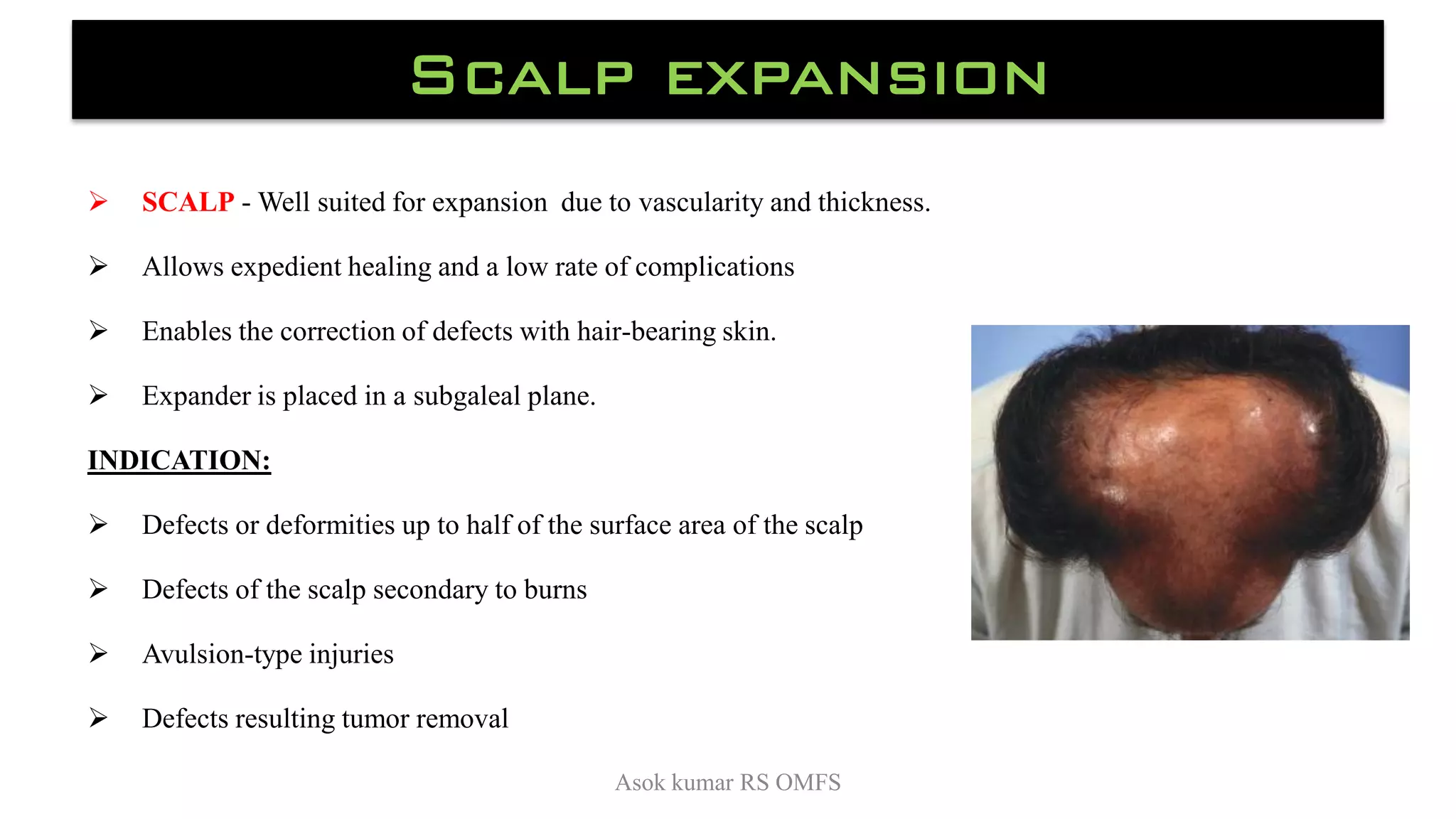 Tissue expander in omfs | PDF