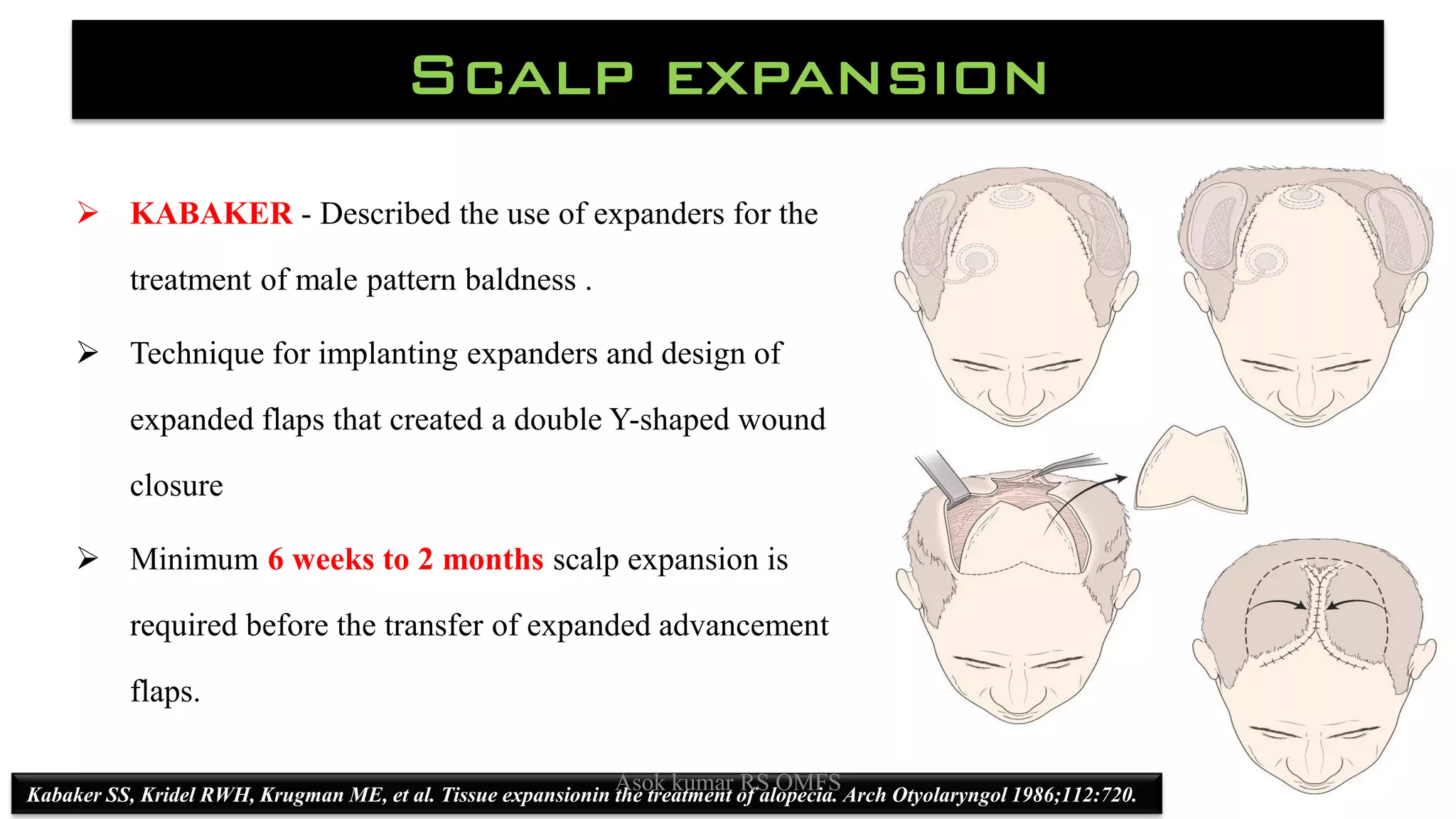 Tissue expander in omfs | PDF