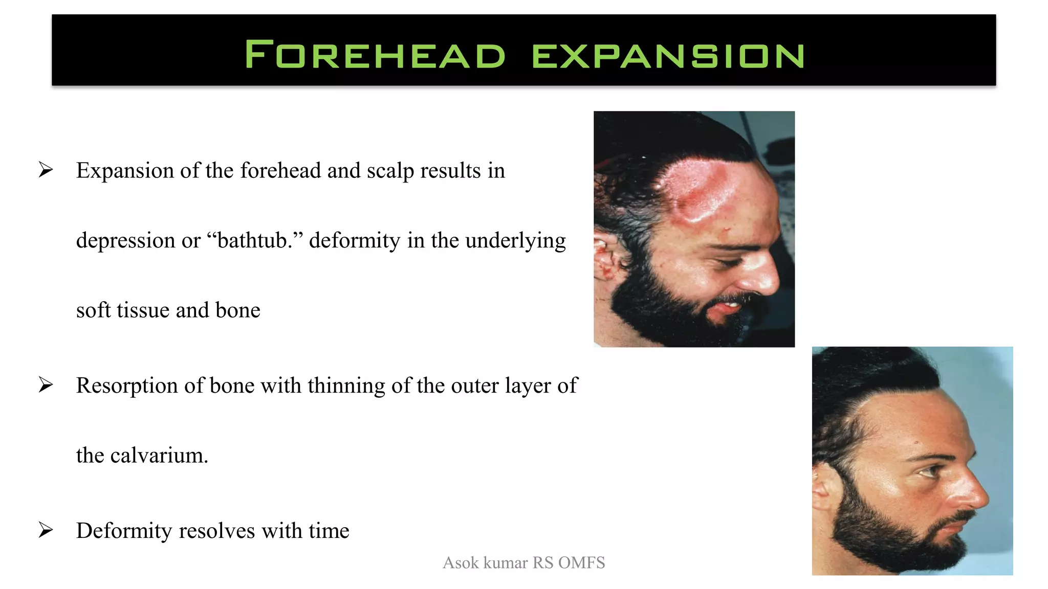 Tissue expander in omfs | PDF