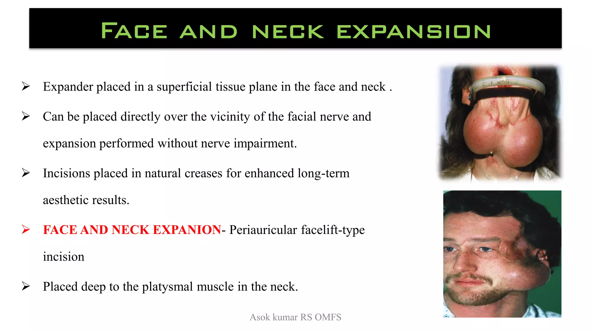 Tissue expander in omfs | PDF