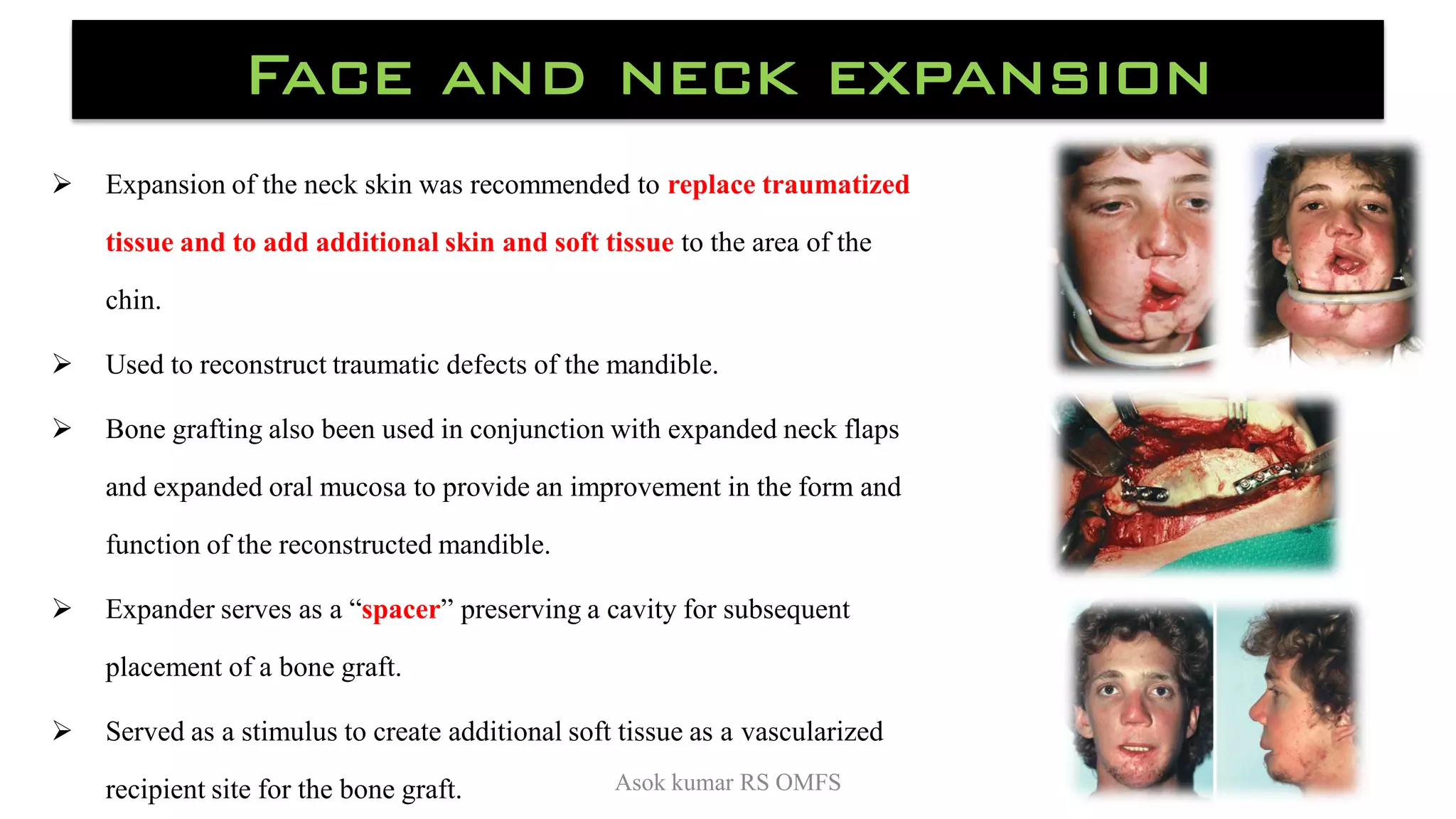 Tissue expander in omfs | PDF