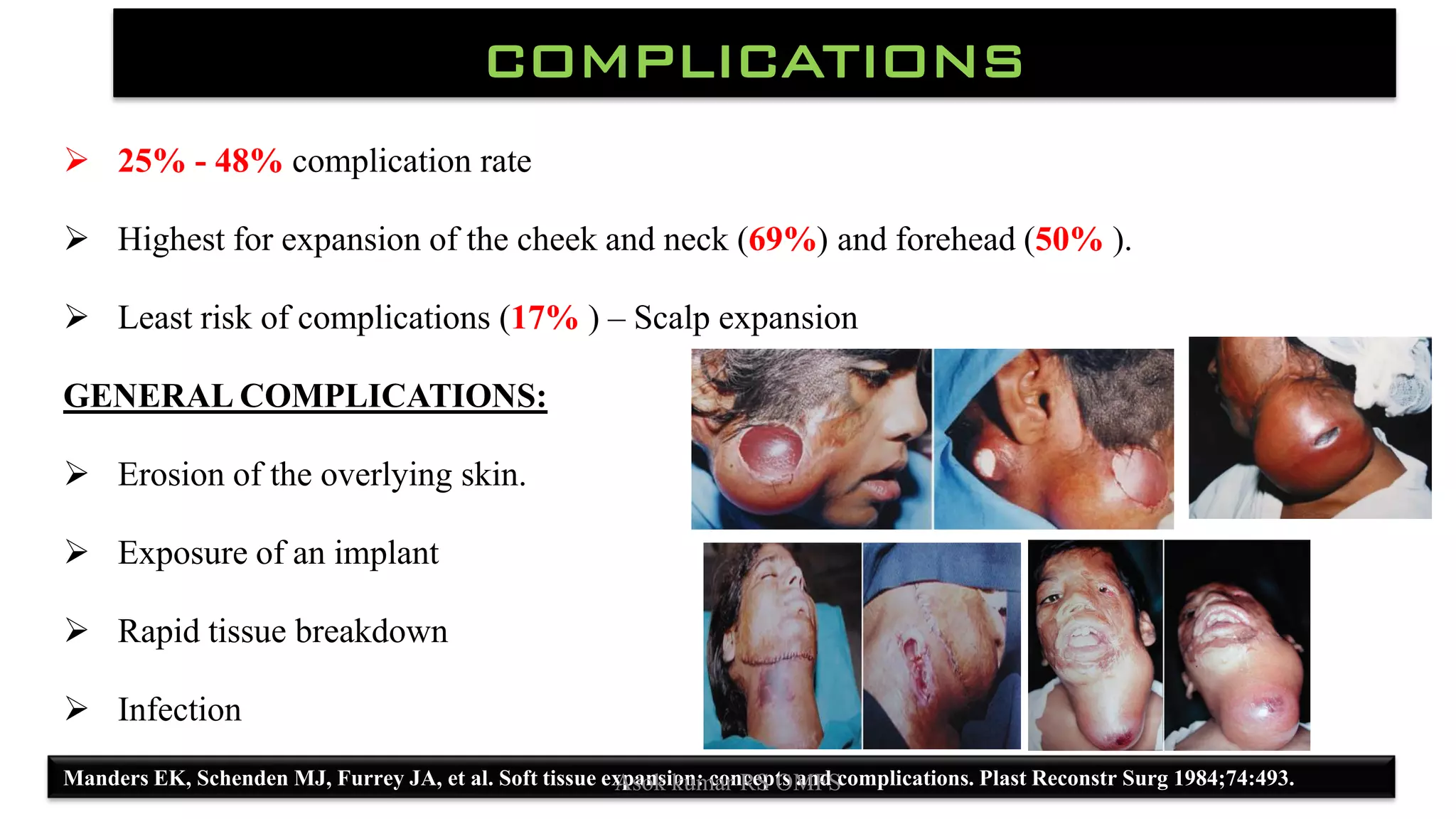 Tissue expander in omfs | PDF