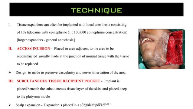 Tissue expander in omfs | PDF | Skin and Dermatology | Diseases and ...