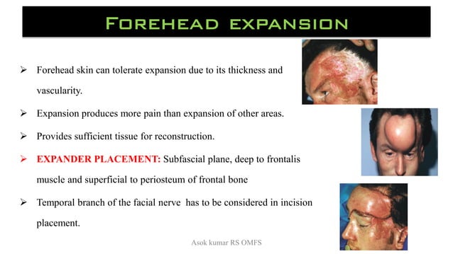Tissue expander in omfs | PDF | Skin and Dermatology | Diseases and ...
