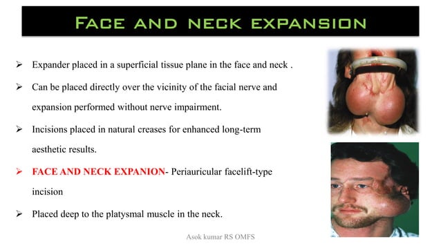 Tissue expander in omfs | PDF | Skin and Dermatology | Diseases and ...