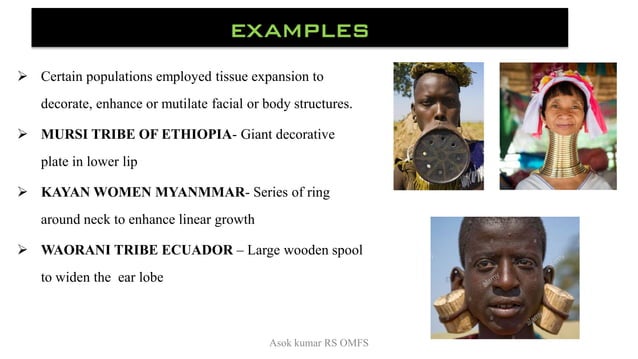 Tissue expander in omfs | PDF | Skin and Dermatology | Diseases and ...