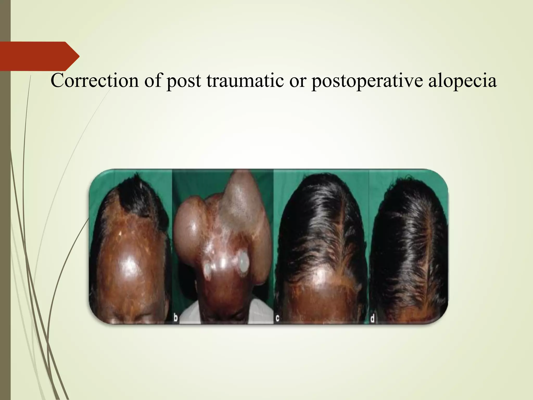 Tissue expanders in oral and maxillofacial surgery | PPTX