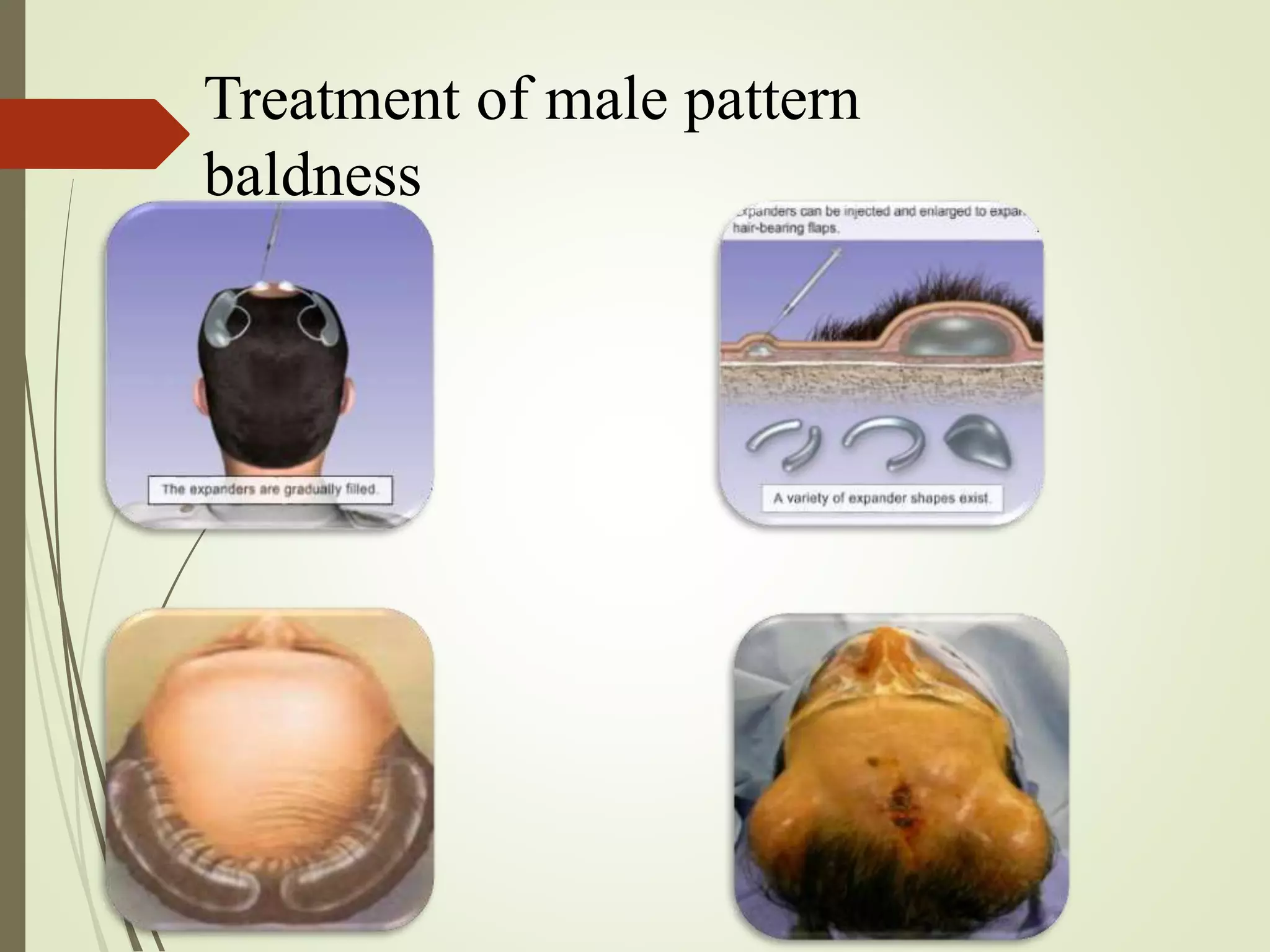 Tissue expanders in oral and maxillofacial surgery | PPTX